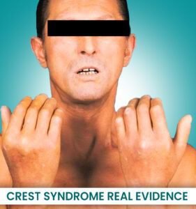 Understanding Crest Syndrome: A Complete Guide