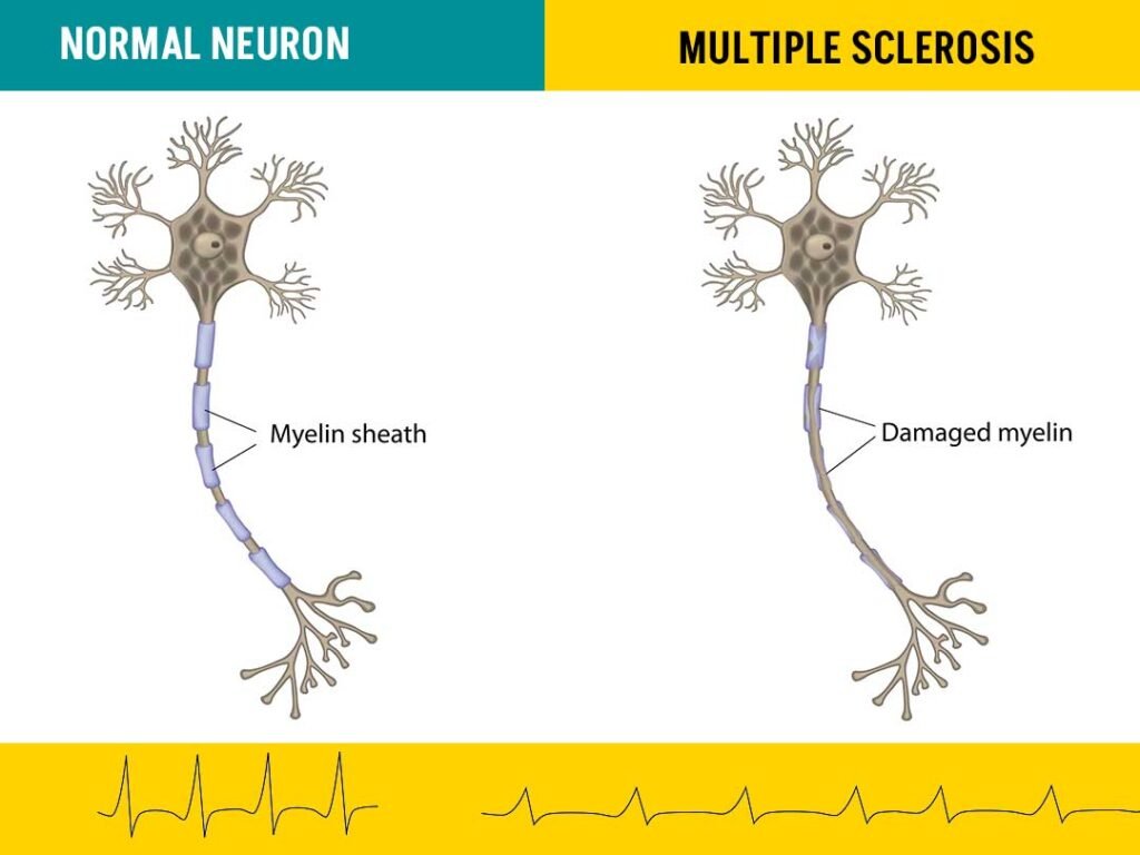 Unveiling The Realities: Multiple Sclerosis Life Expectancy In The USA
